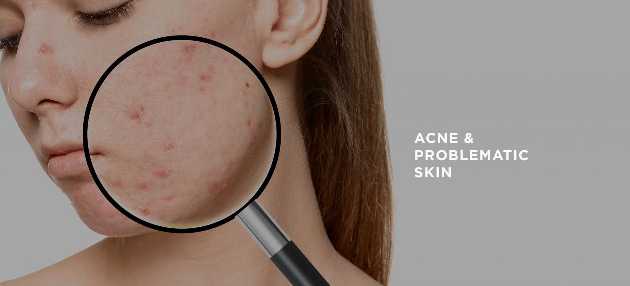 Acne and problematic skin | WISHPro Asia